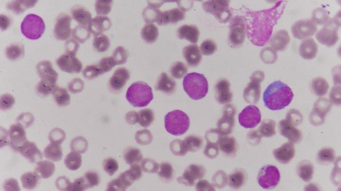 Apa Itu Leukemia? Ini Penyebab, Pengobatan, hingga Jenis-jenisnya ...