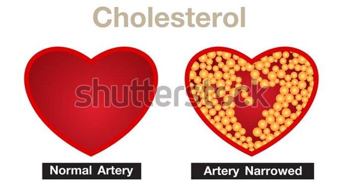 5 Tanda yang Dirasakan Tubuh Jika Kadar Kolesterol Naik, Kesemutan ...