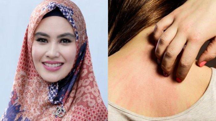 Berita Penyakit Stevens Johnson Syndrome Terbaru Hari Ini - Tribun ...