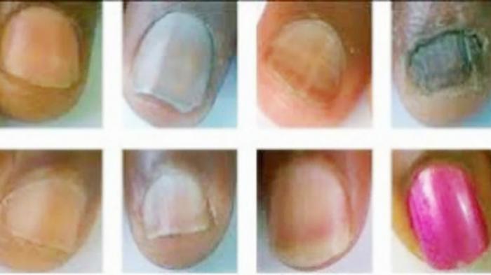 Kuku Anda Bentuk, Warnanya Apa? Ternyata ini Cara Ketahui Penyakit Diderita - Halaman all ...