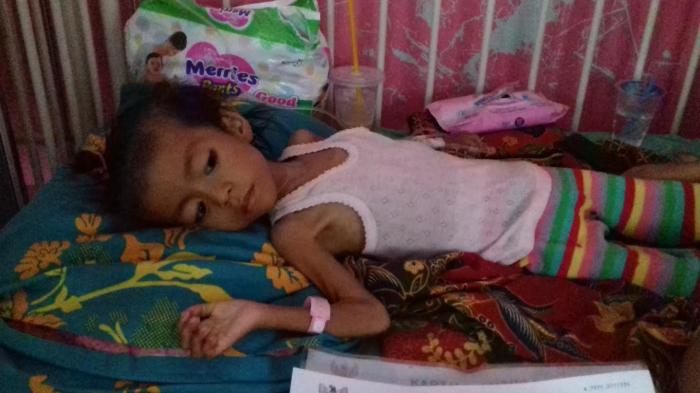 Bocah Empat Tahun Penderita Busung Lapar Dirawat di RS Labuang Baji ...