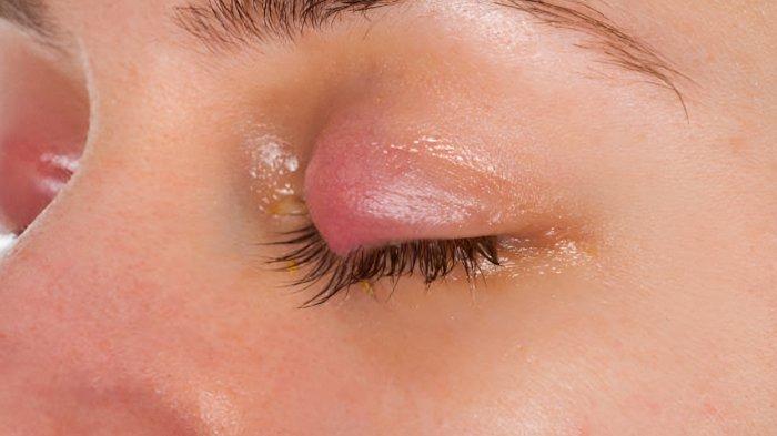 Kenali Penyabab Mata Bintitan, Simak Tips Pengobatan dari IDI Kota ...