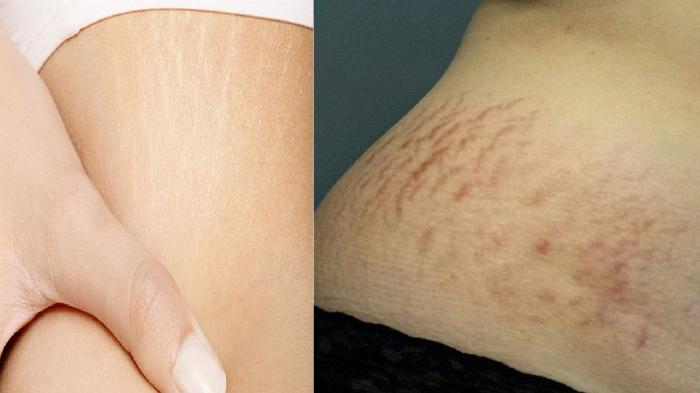 Stretch Mark di Paha dan Perut Hilang, Hanya Pakai Lemon, Ini Caranya ...