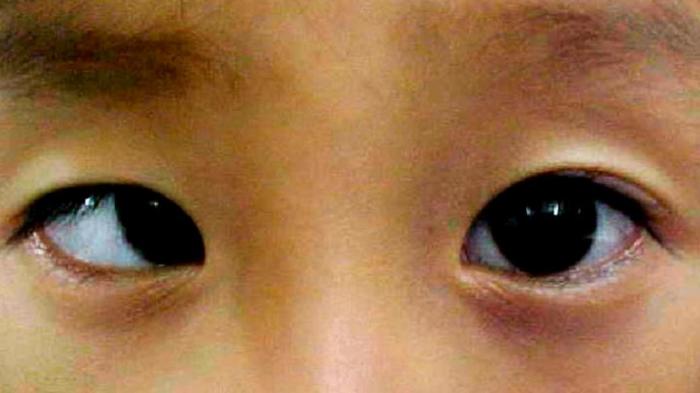 Boleh Dicoba, Cara Menormalkan Kembali Mata Juling - Tribun-timur.com