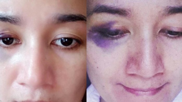 Lama Menghilang, Artis Nini Karlina Unggah Foto Wajah Babak Belur, Ini ...