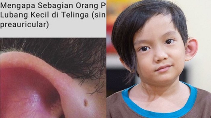 4 Fakta Sinus Preauricular, Lubang Kecil yang Membuat Telinga Anak Anji ...