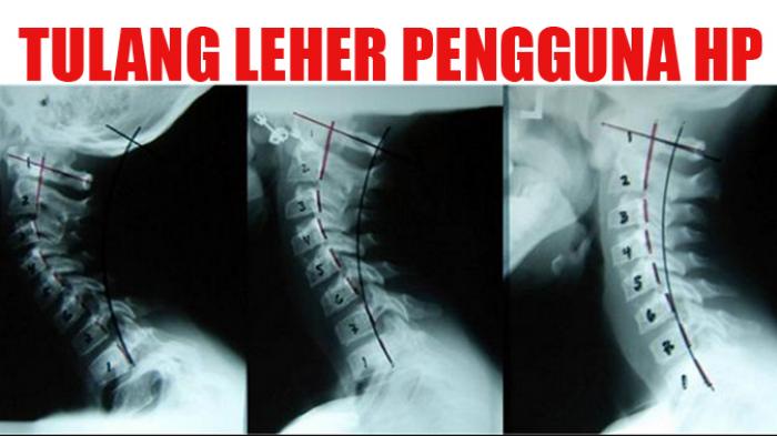 Beginilah Bengkoknya Tulang Leher Pengguna HP yang Sering Tunduk ...