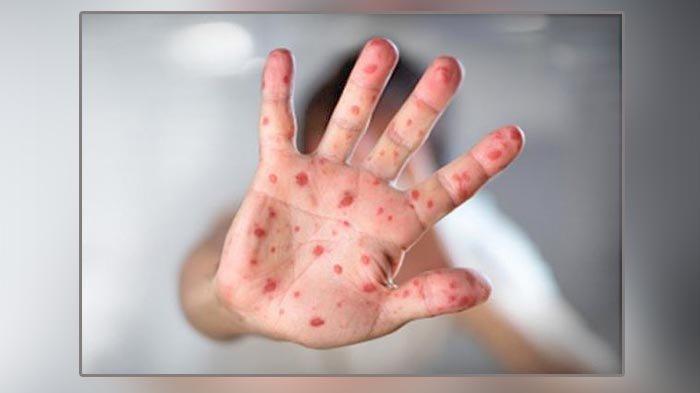 Campak atau Morbili, Ini Cara Penularan dan Gejala Penyakit Ini Jika ...