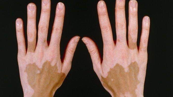 Apa Itu Vitiligo? Penyakit yang Membuat Kondisi Kulit Alami Bercak ...