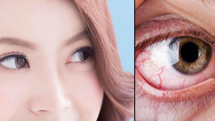 7 Penyakit Berbahaya yang Bisa Dideteksi dari Mata, Simak Penjelasannya ...