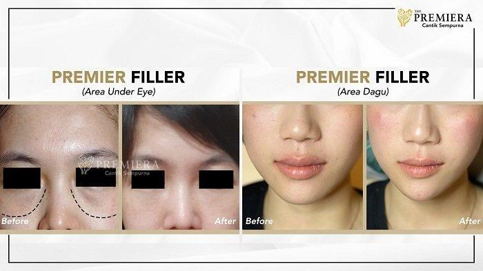 Apa Itu Botox, Filler, Threadlifts dan DNA Healer? Simak Perbedaannya ...