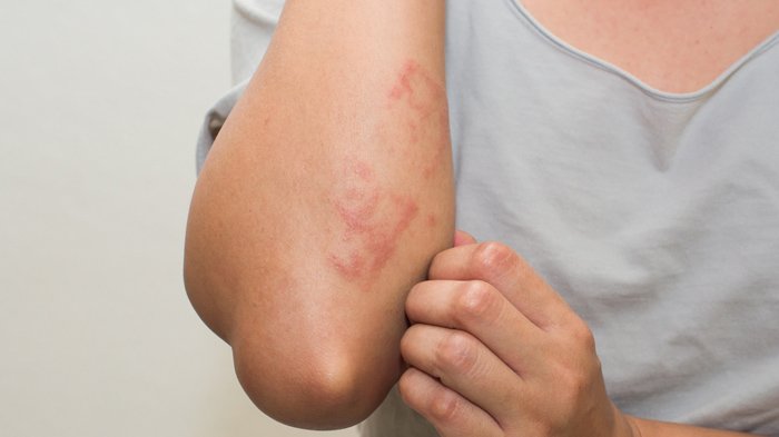 Mengenal Penyebab Biduran dan Cara Mengatasinya - Tribunmanado.co.id