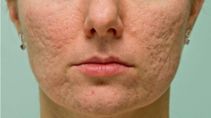 Ternyata Bopeng Bekas Jerawat di Wajah Bisa Lenyap, Asal Konsisten ...