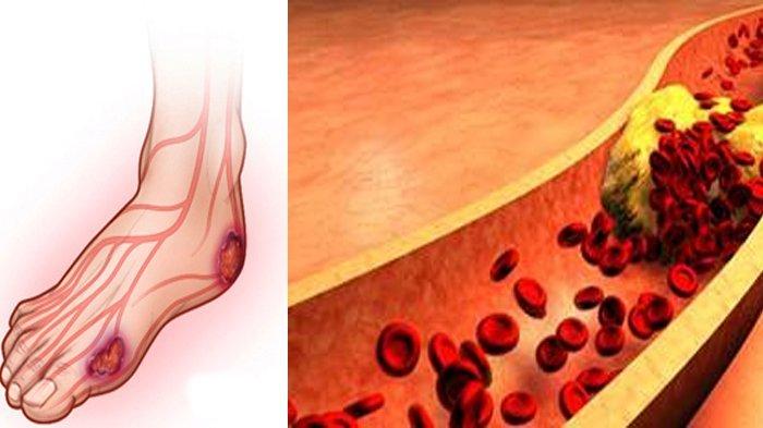 Siapa Sangka Sering Haus dan Buang Air Kecil, Ternyata Ada Gejala ...