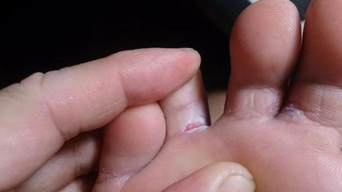 Kutu Air Anda Bernanah? Berikut Cara Mengobatinya - Tribunmanado.co.id