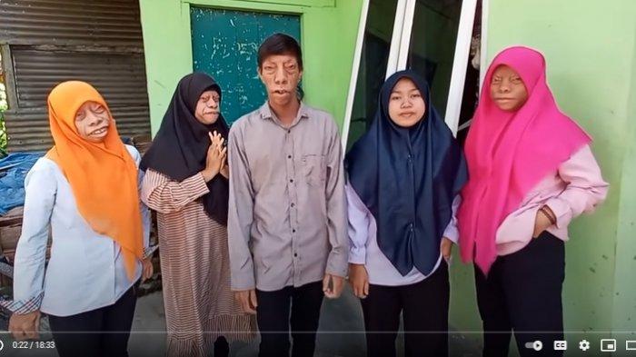 Masih Ingat Keluarga Manurung? Viral Idap Penyakit Langka, Kini Makin ...
