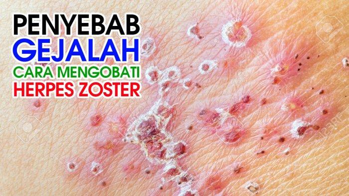 Kenali Penyebab dan Gejala Penyakit Herpes Zoster, Serta Cara Mengobatinya - Tribunmanado.co.id