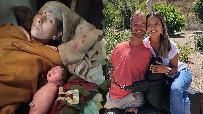 Mengenal Sindrom TETRA-AMELIA, Kelainan yang Diduga Penyebab Bayi yang ...