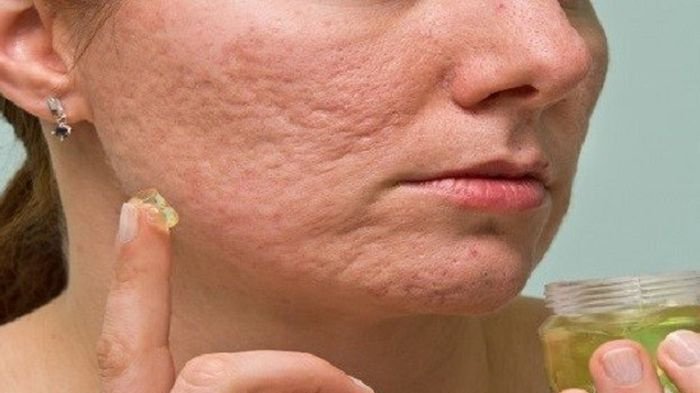 Kulit Wajah Bisa Rusak dengan Kebiasaan Tidur Seperti Ini, Salah ...