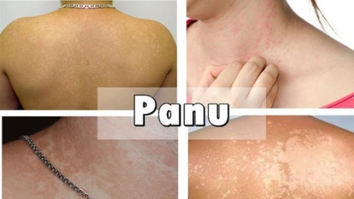 Penderita Panu Harus Hindari Beberapa Jenis Makanan, Berikut Daftarnya ...