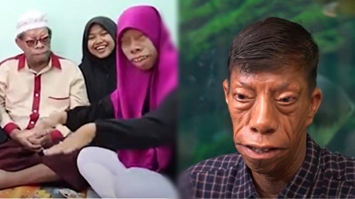 Potret Keluarga Manurung, Viral 5 Anggotanya Idap Sindrom Langka, Kini ...