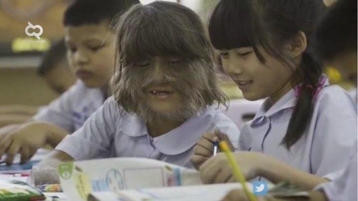 Masih Ingat Supatra Sasuphan? Dulu Dihina, Kini Wanita Wajah 'Serigala ...