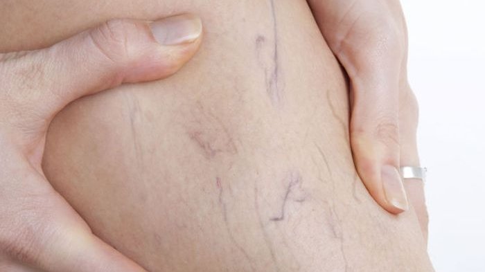 9 Cara Menghilangkan Varises Secara Alami, Nomor 7 Atur Posisi ini ...