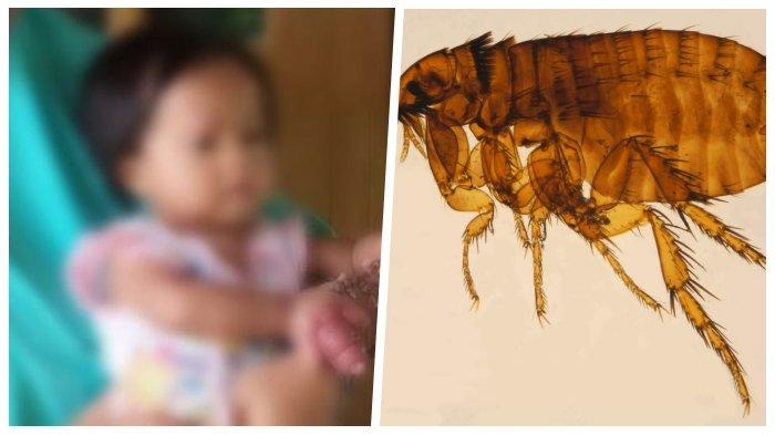 Waspada! Lantaran Digigit Kutu Kucing Sejak Usia 4 Bulan, Jari Bocah ...