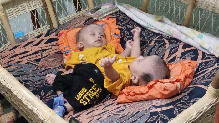 PRIHATIN, Adam dan Malika Bayi Kembar Siam Asal Deliserdang ini Membutuhkan Uluran Tangan ...