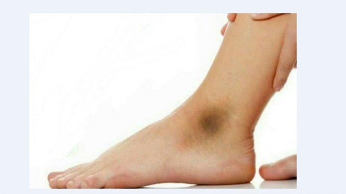 CARA Mencerahkan Mata Kaki yang Menghitam, Pakai Kunyit hingga Mentimun ...
