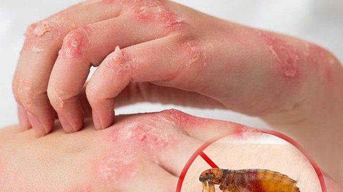 Mengerikan, Bermula Digigit Kutu, Kedua Lengan Pria Ini Harus ...