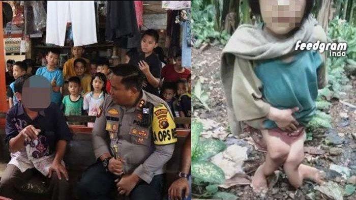 Akhirnya Terungkap Keberadaan Ortu Kandung Bocah Perempuan di Nias yang Dianiaya hingga Kaki ...