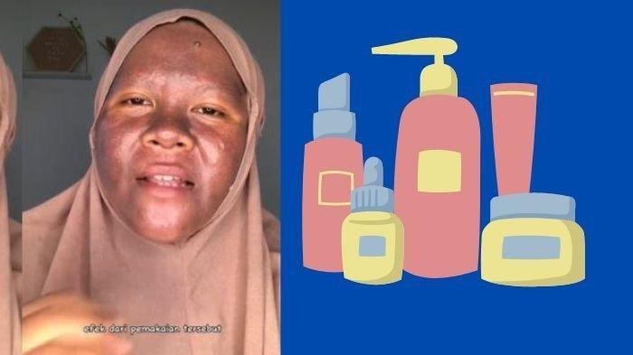 Salah Pilih Skincare, Wajah Konten Kreator ini Gosong, Dua Tahun Tak ...