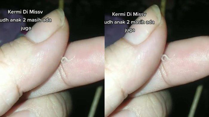 Viral Wanita Keluhkan Cacing Kremi Keluar dari Miss V - Tribun-medan.com
