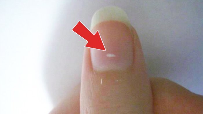 5 Jenis Bintik Putih di Kuku yang Harus Kamu Tahu, Bisa Jadi Tanda Penyakit Loh - Tribun-medan.com