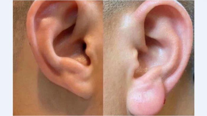 Gadis Ini Jadi Tuli Usai Dicium Pacarnya, Gendang Telinga Pecah, Dokter ...