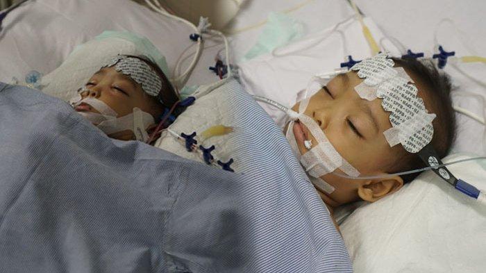 Bayi Kembar Siam Adam dan Aris Kembali Jalani Operasi ke-3 - Tribun-medan.com