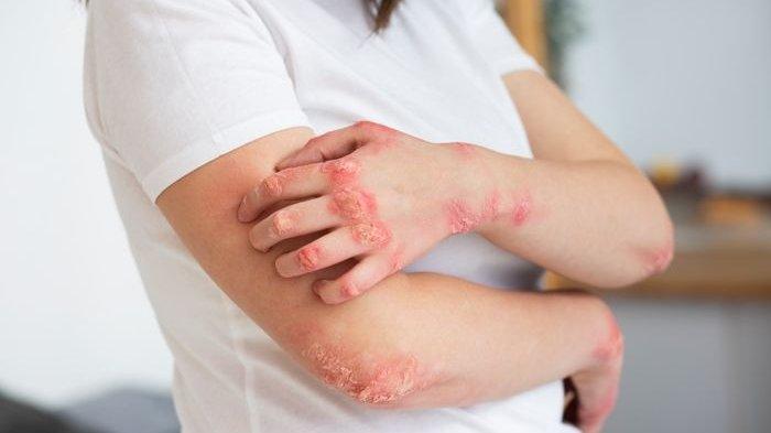 Cara Mengatasi Kurap yang Sangat Mengganggu Aktivitas - Tribun-medan.com