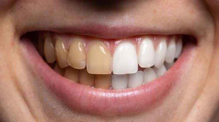 Penyebab Gigi Kuning dan Cara Mengatasinya Menggunakan Bahan Alami ...