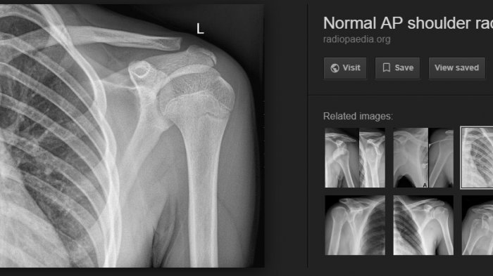 Lenggan Bahu Terkilir, Kondisi Terkini Mohamed Salah hingga Kemungkinan ...