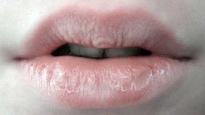 6 Tips Mengatasi Bibir Kering dan Pecah-Pecah dengan Bahan Alami - Tribun-medan.com