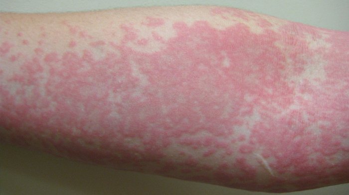 Bisa Membahayakan, Inilah Penyebab, Gejala dan Cara Mengatasi Alergi ...