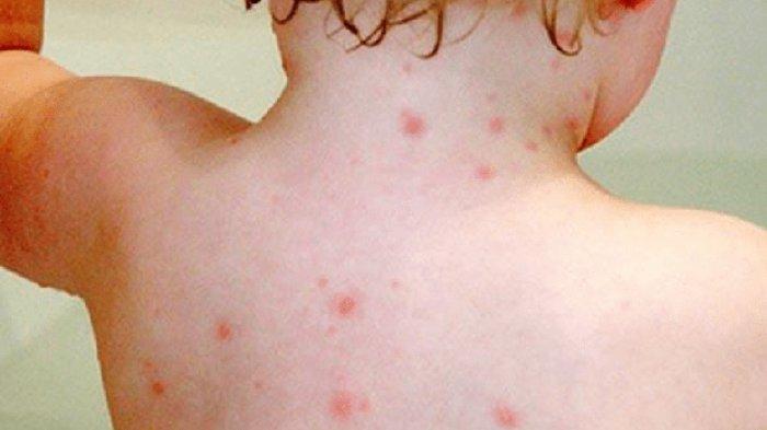 Curiga Ada Ruam Merah di Tubuh Bayinya, Pasutri Ini Syok Tahu si Kakak ...