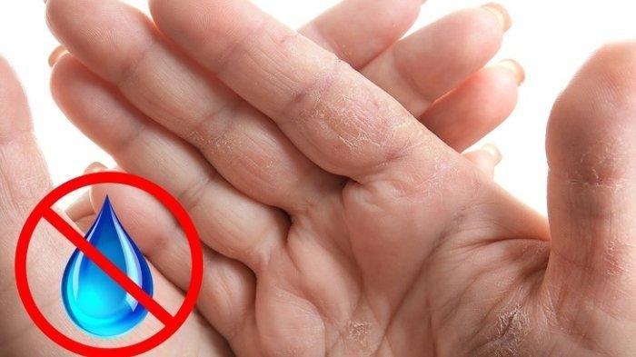 Ketahui 4 Cara Mengatasi Kulit Tangan yang Kering, Gunakan Bahan-bahan ...