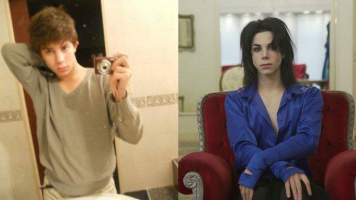 Idolakan Michael Jackson,Leo Rela Operasi Belasan Kali, Ini ...