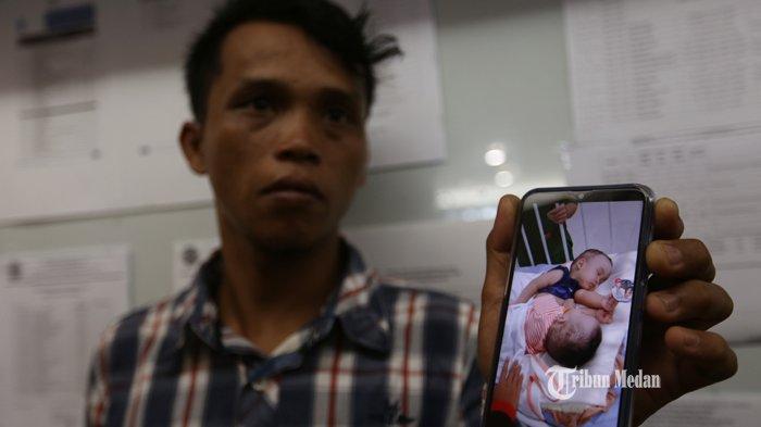 BERITA FOTO Operasi Pemisahan Bayi Kembar Siam Adam dan Malik Berjalan Sukses - Tribun-medan.com