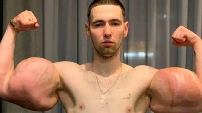 Popeye Rusia Terancam Diamputasi, Menyesal Suntikkan 6 Liter Petroleum ...