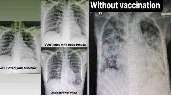 Foto Rontgen Paru-paru Pasien Covid-19 yang Sudah dan Belum Divaksin ...