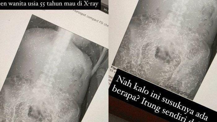 Tubuh Seorang Wanita 55 Tahun Dipenuhi Susuk Tembaga dan Emas, Foto X ...