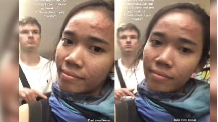 Punya Banyak Jerawat, Curhat Wanita Minder Dipacari Bule: Gak Jijik ...